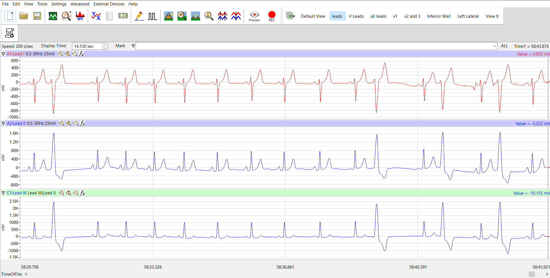 Arrhythmia Research - iWorx Systems Inc
